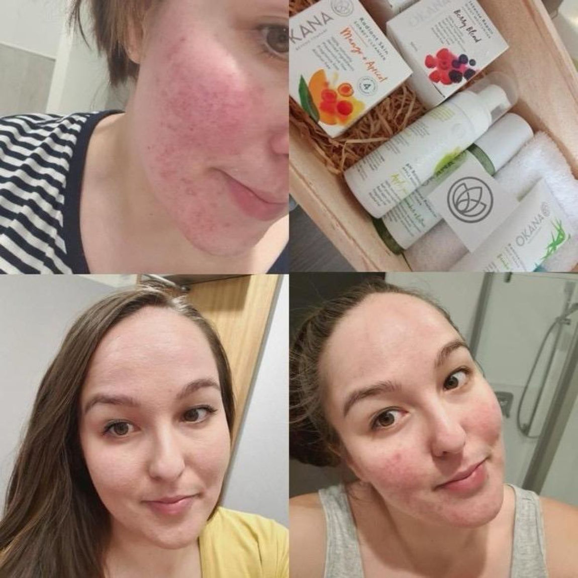 How to Create a Skincare Routine for Eczema-Prone Skin